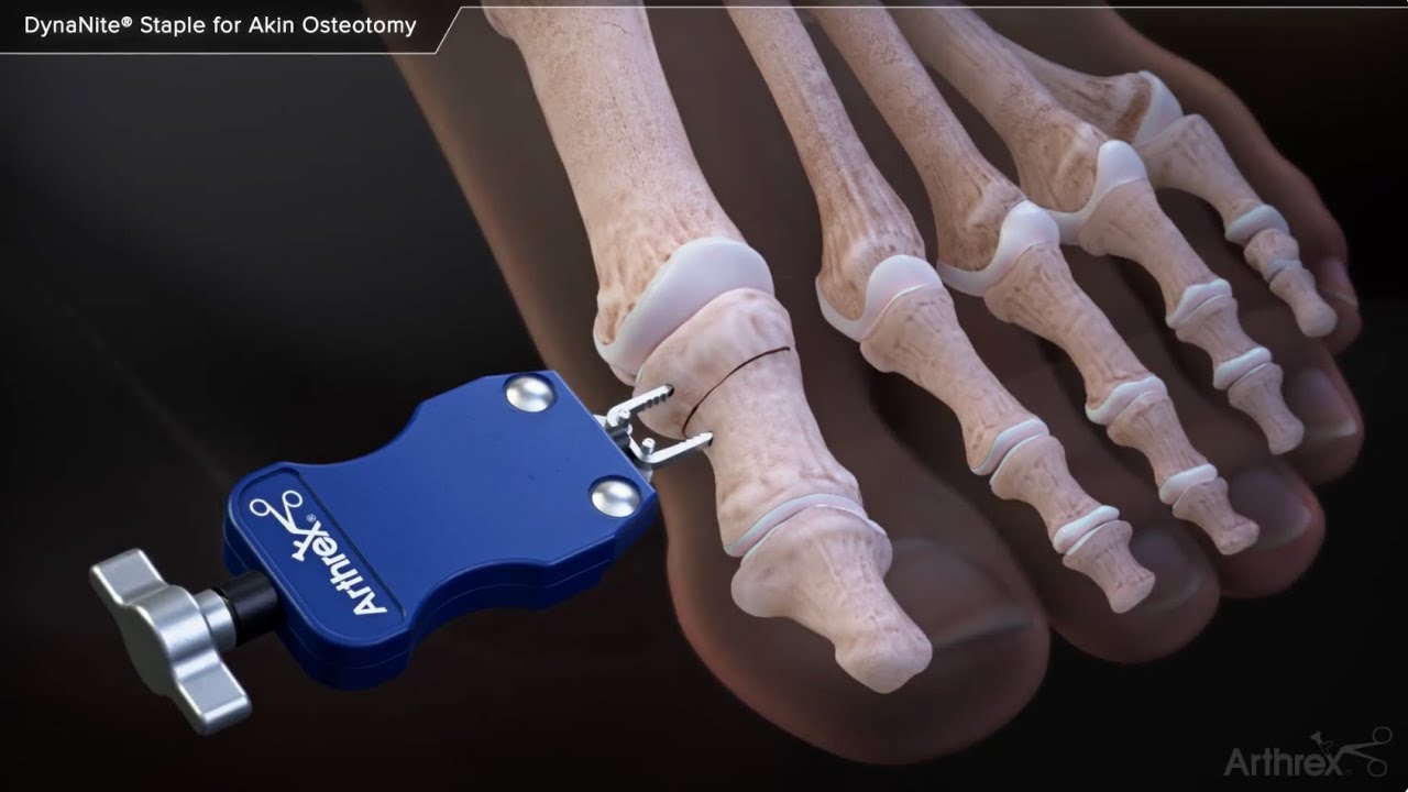 DynaNite® Staple for Akin Osteotomy - YouTube