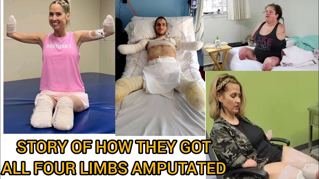 People Who Had All FOUR LIMBS Amputated - YouTube