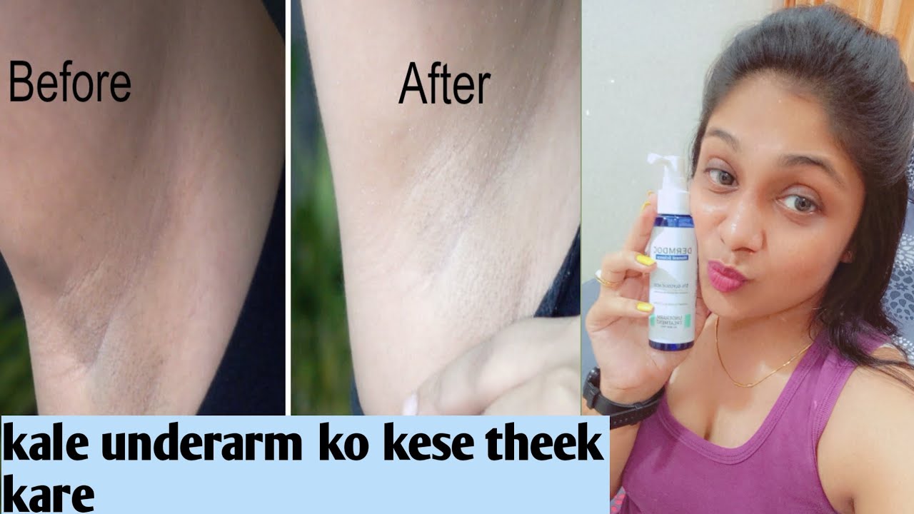 dermdoc underarm Treatment ||dark underarm ko white kese kare ...
