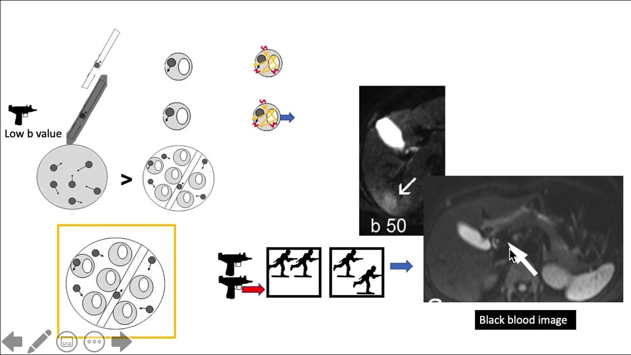 Diffusion weighted imaging (3/4)- DWI, ADC & b values simplified - YouTube