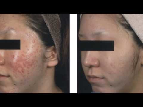 Endymed 3DEEP Lifting BEFORE & AFTER 1 - YouTube