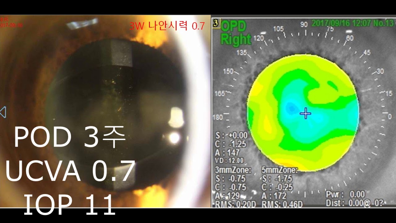 Optic Capture in cataract with Weak Zonule - YouTube