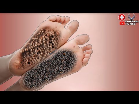 ASMR Animation Treatment from Infected Men Foot | ASMR severely loosing ...