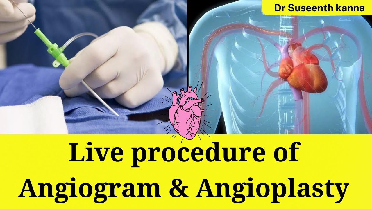 Live explanation of Coronary angiogram and angioplasty - YouTube