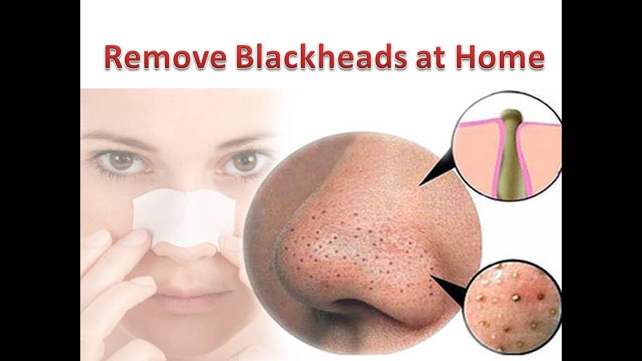 How To Remove Black And White Heads Naturally At Home YouTube how-to-remove-black-and-white-heads-naturally-at-home-youtube