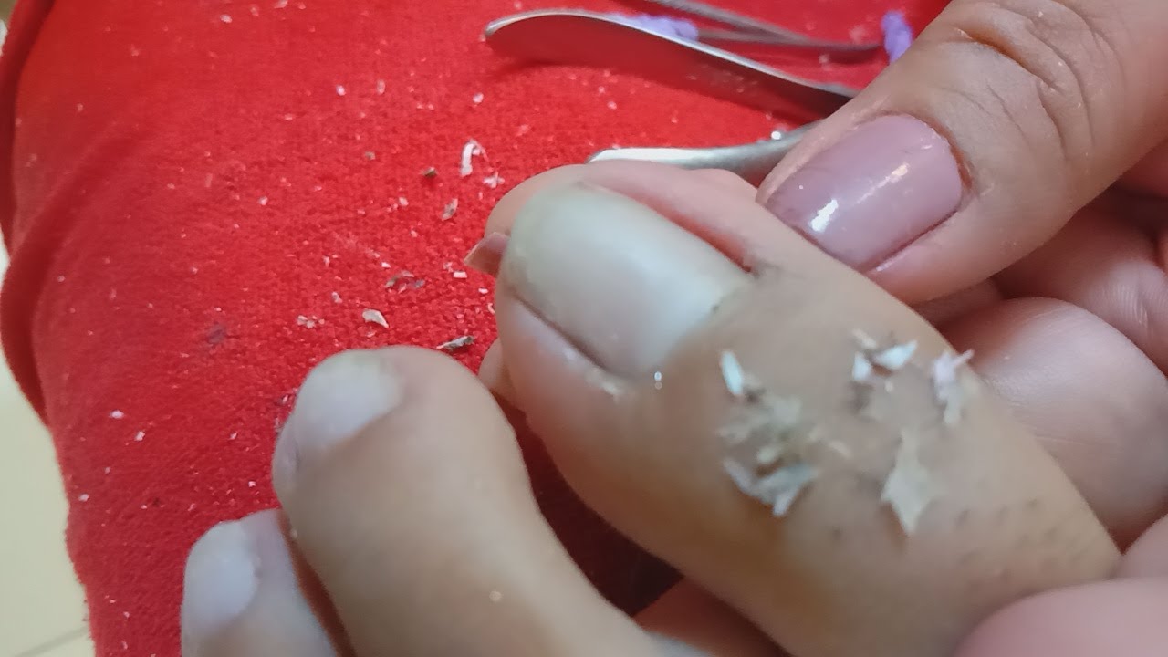 INGROWN REMOVAL PEDICURE CLEANING /SATISFYING / CLIENT99 ...