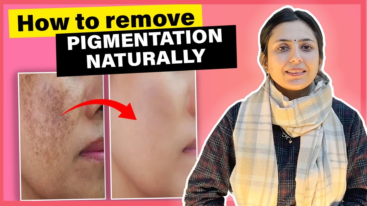 Natural Remedies for Pigmentation | Clear & Glowing Skin | Upasana Ki ...
