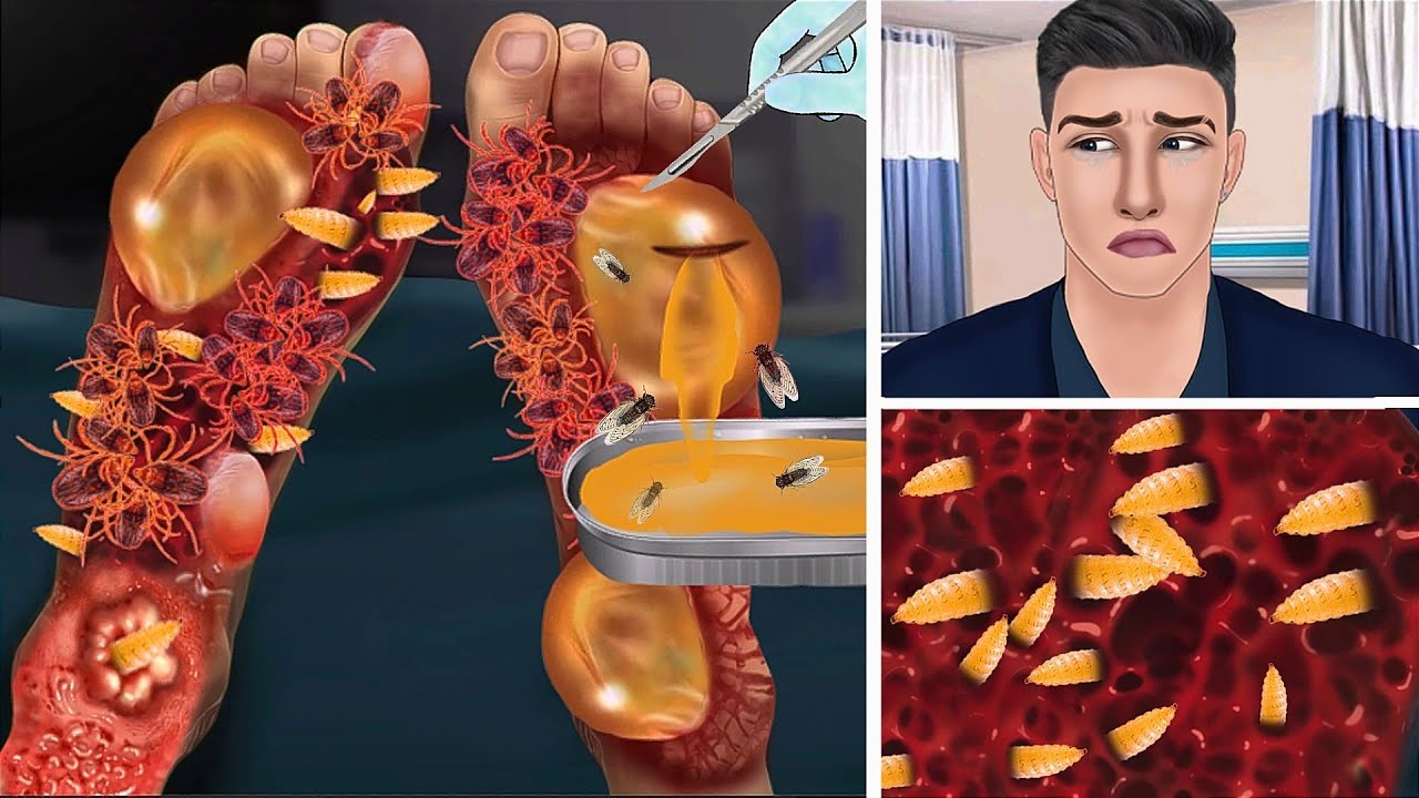 ASMR Animation treatment from infected foot | maggot remove | 2d ...