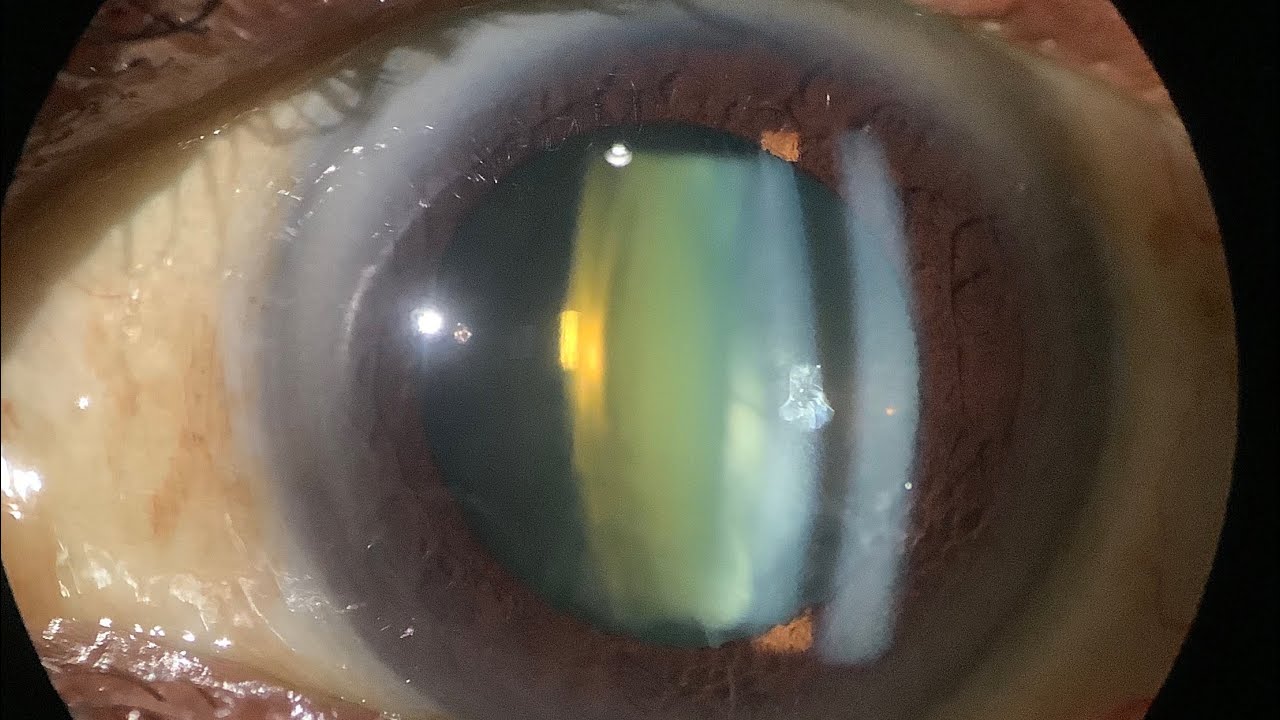 Dense Cataract Surgery Step by Step - YouTube