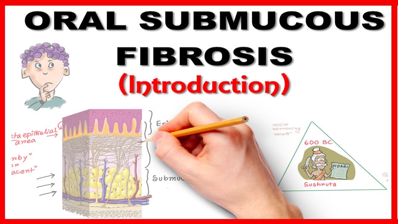 Oral Submucous Fibrosis (OSMF) Introduction - YouTube