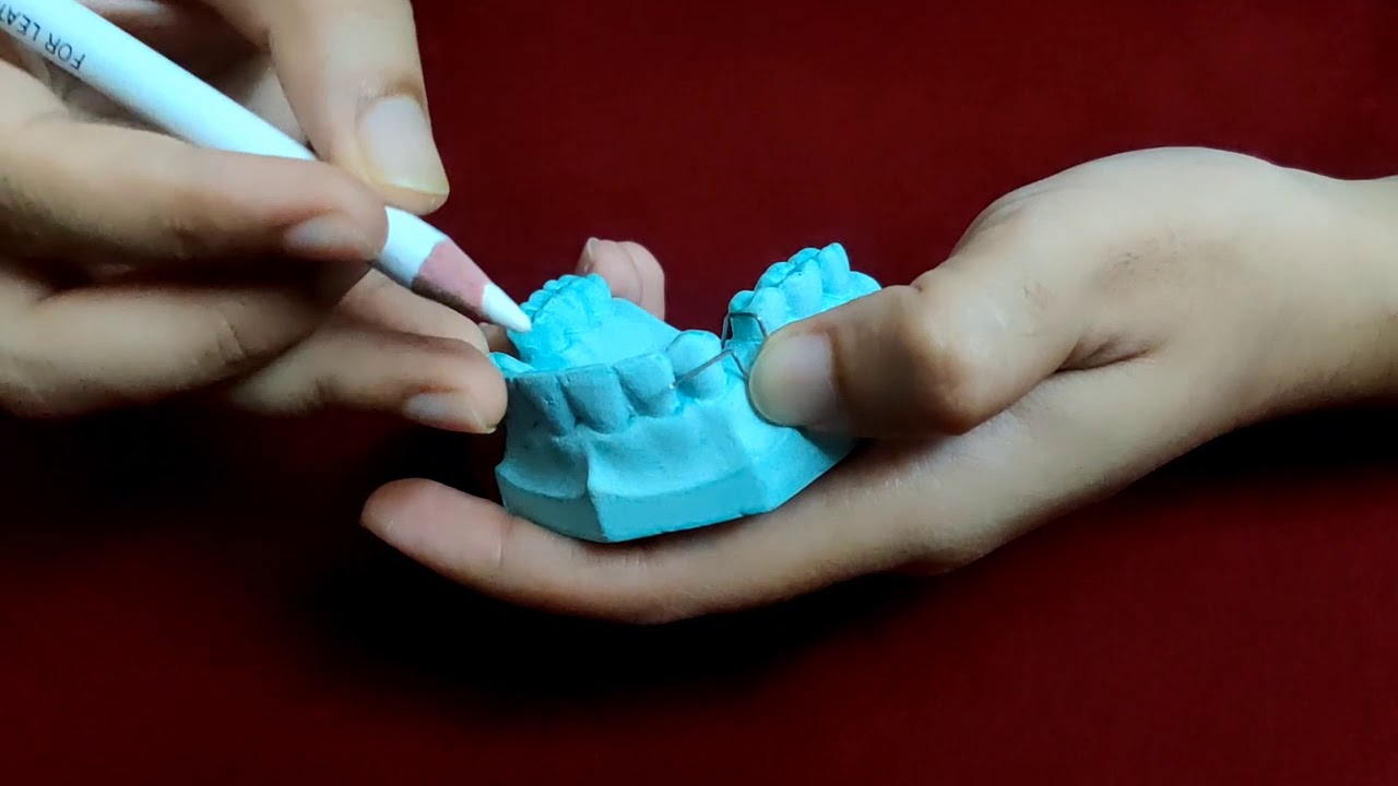 U loop canine retractor, ORTHO GDC NAGPUR - YouTube