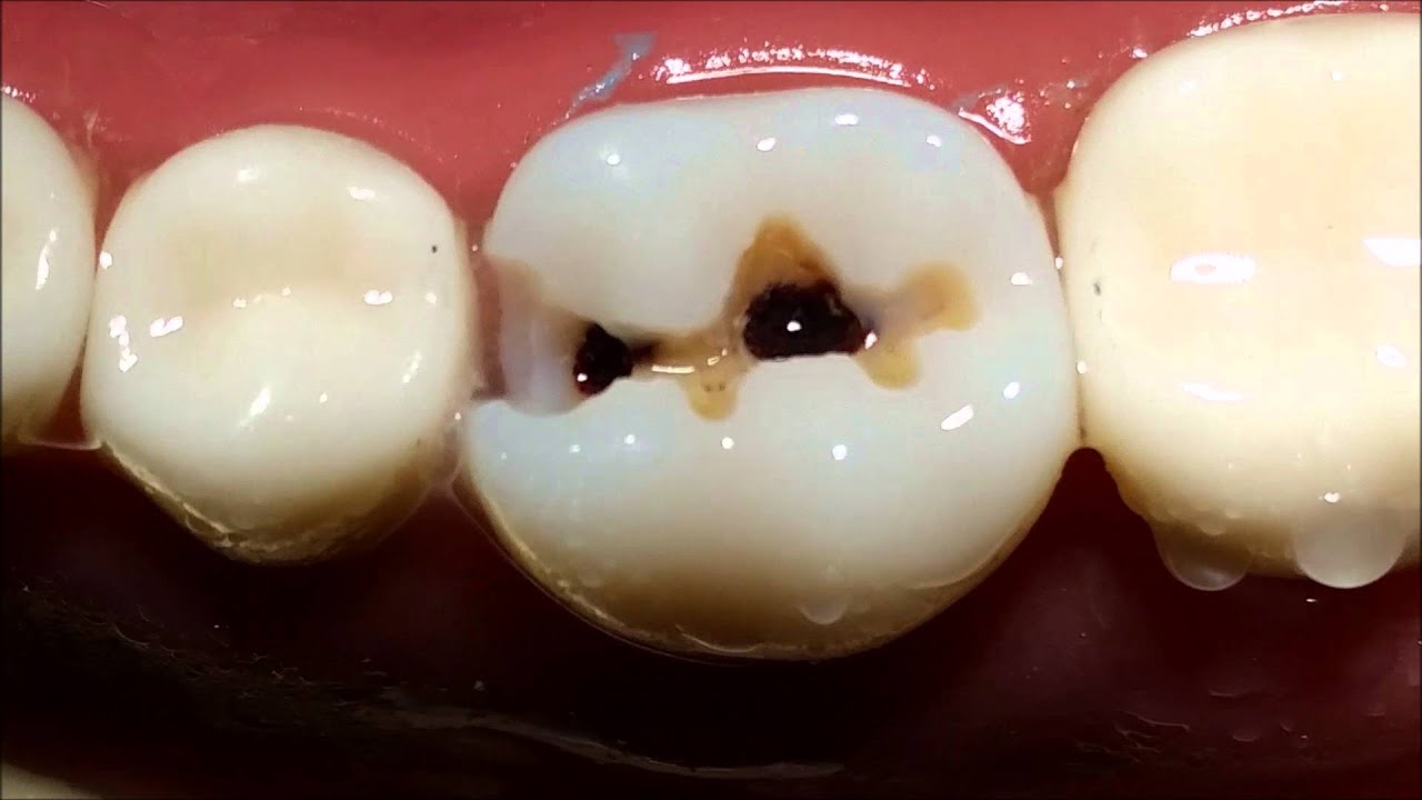 Class II Amalgam - OM # 36 Carious tooth - YouTube