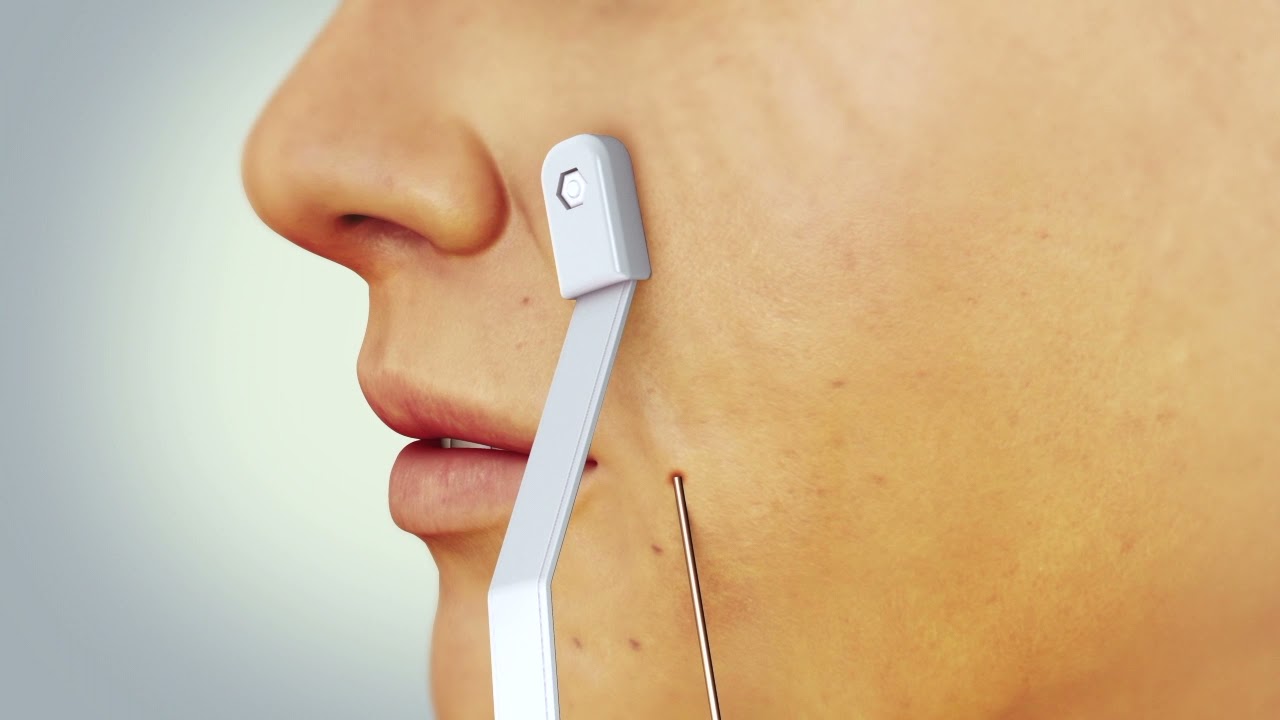 BodyTite and FaceTite by InMode Animation Video - YouTube