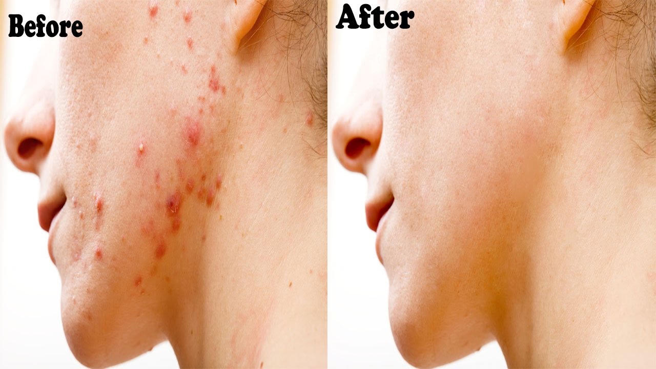 Remove Acne In Simple 1 Step On Photoshop Cs6 2017 YouTube remove-acne-in-simple-1-step-on-photoshop-cs6-2017-youtube