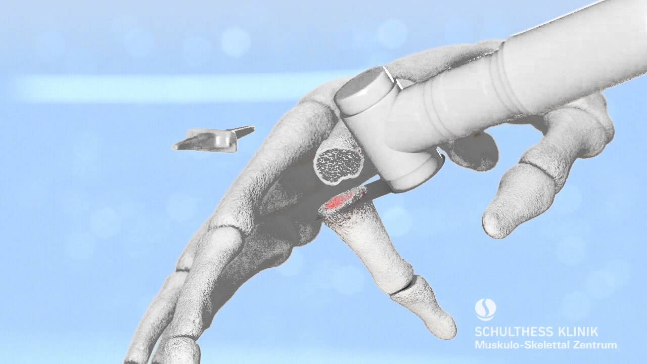 «Fingergelenksarthrose - Silikon Kunstgelenk» - Schulthess Klinik - YouTube