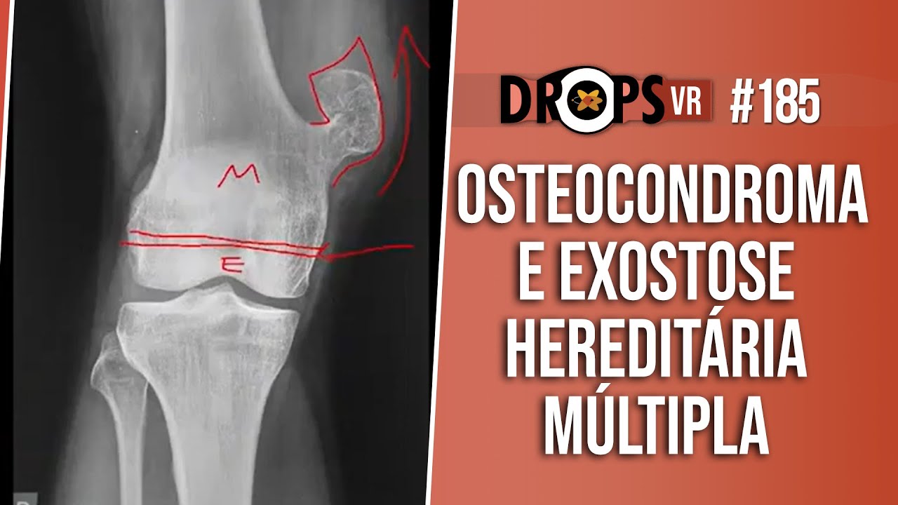 OSTEOCONDROMA E EXOSTOSE HEREDITÁRIA MÚLTIPLA - YouTube