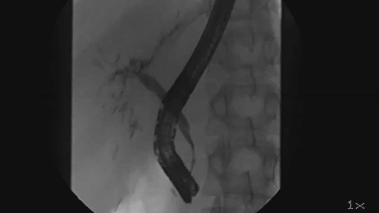ERCP Findings in PSC - YouTube