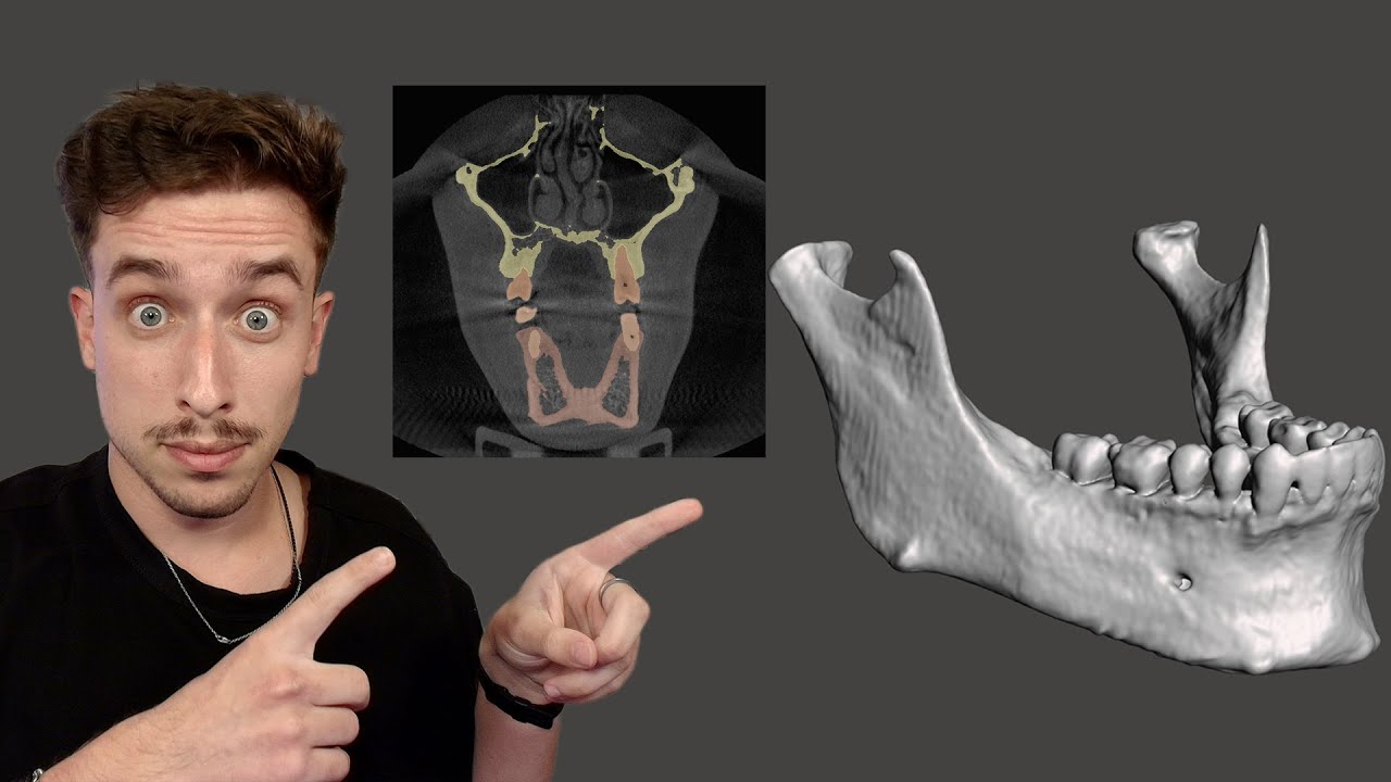 How to 3D Print a Jaw from CBCT Using Free Software - 3D Slicer, Dental ...