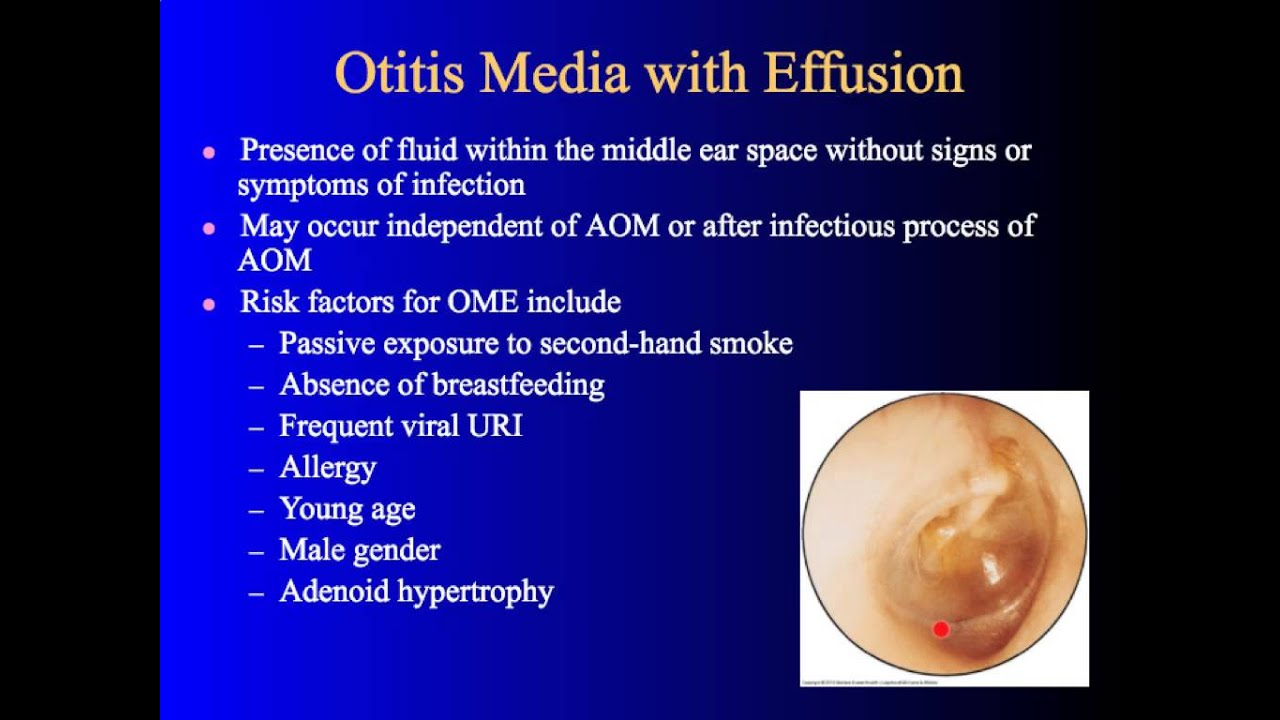 Otitis Media Pictures