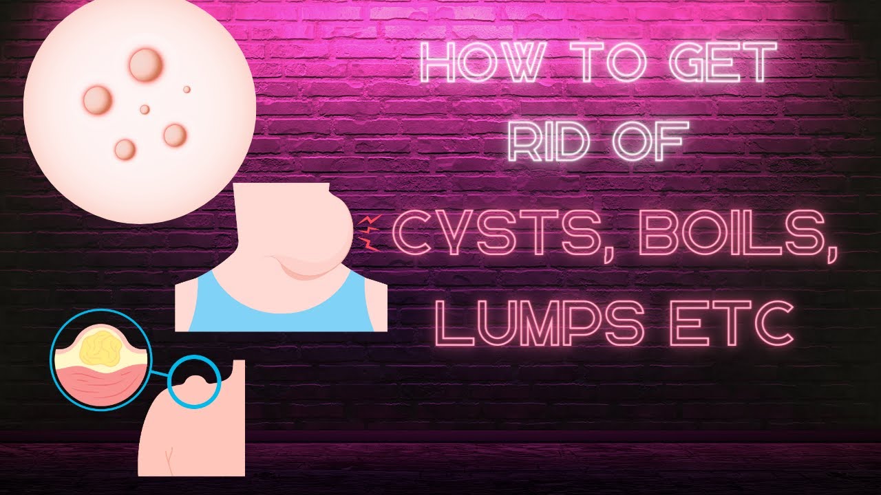 ⚠️HOW TO GET RID OF CYSTS, BOILS ETC ⚠️ - YouTube