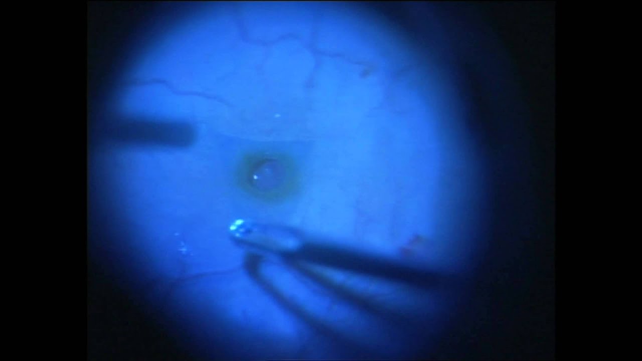 Modified Inverted Flap Technique for Mac Hole - YouTube