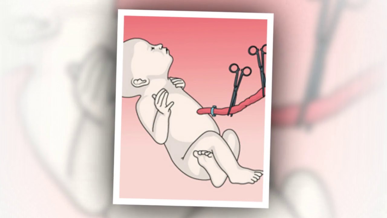 Active management of 3rd stage of labour AMTSL - YouTube