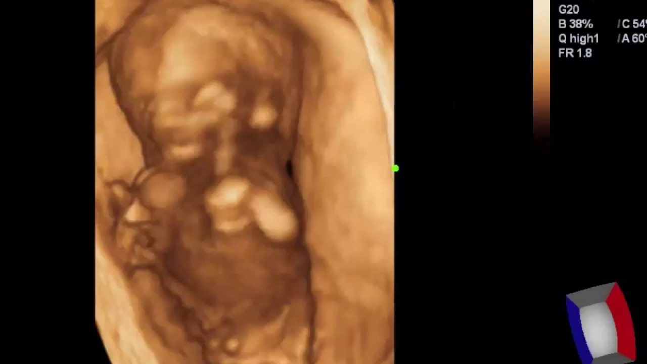 CASE 373 2D 3D 4D FETAL PHOCOMELIA MEROMELIA - YouTube