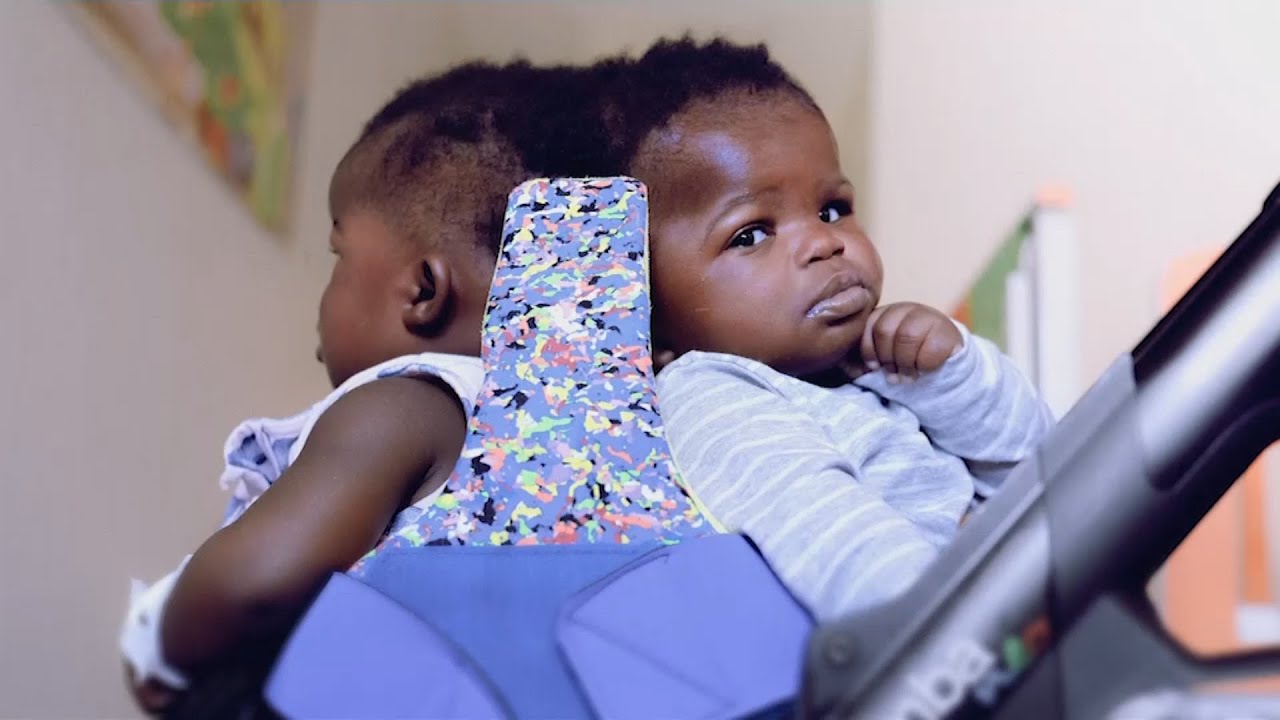 Conjoined twin girls successfully separated in Vatican City - YouTube