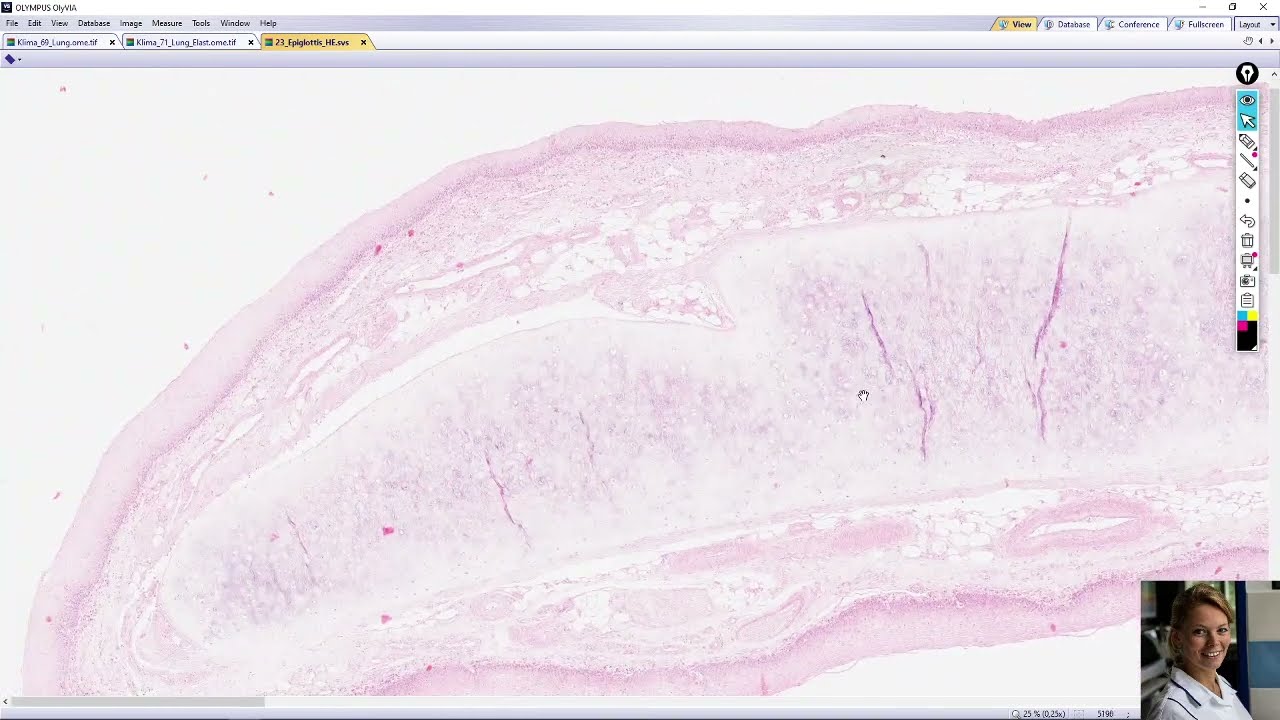 epiglottis - YouTube