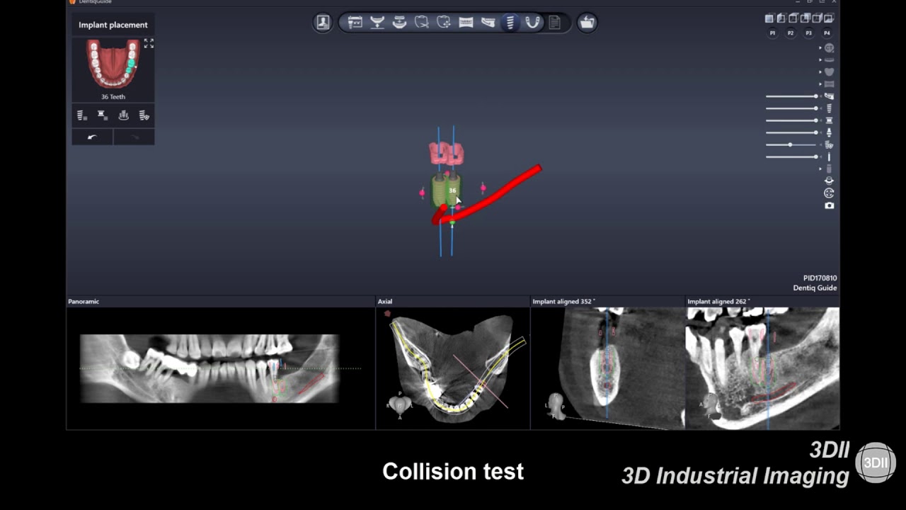 EDI Present a top Surgical Guide Design S/W, Dentiq - YouTube