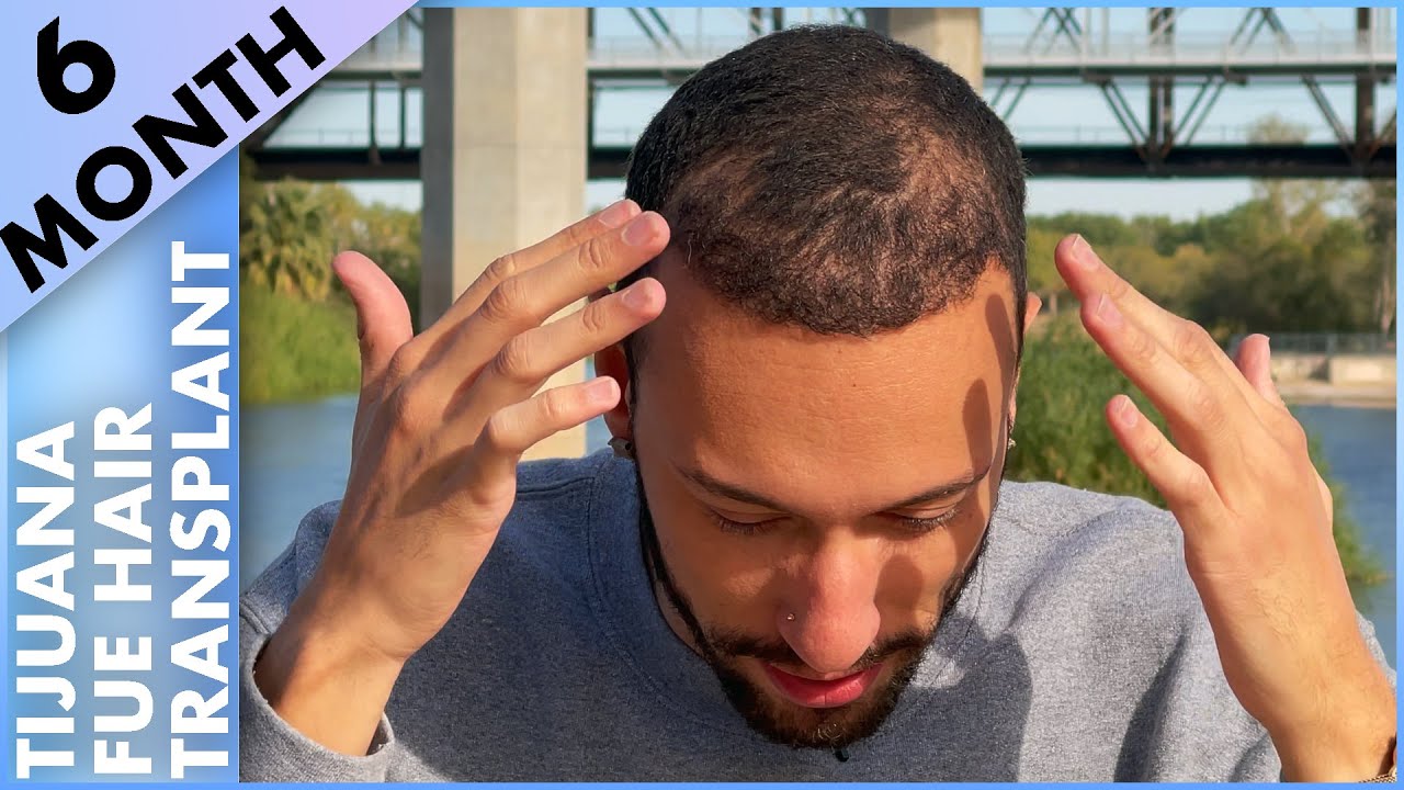 Month 6 | FUE Hair Transplant In Tijuana | Biracial Black Afro Hair ...