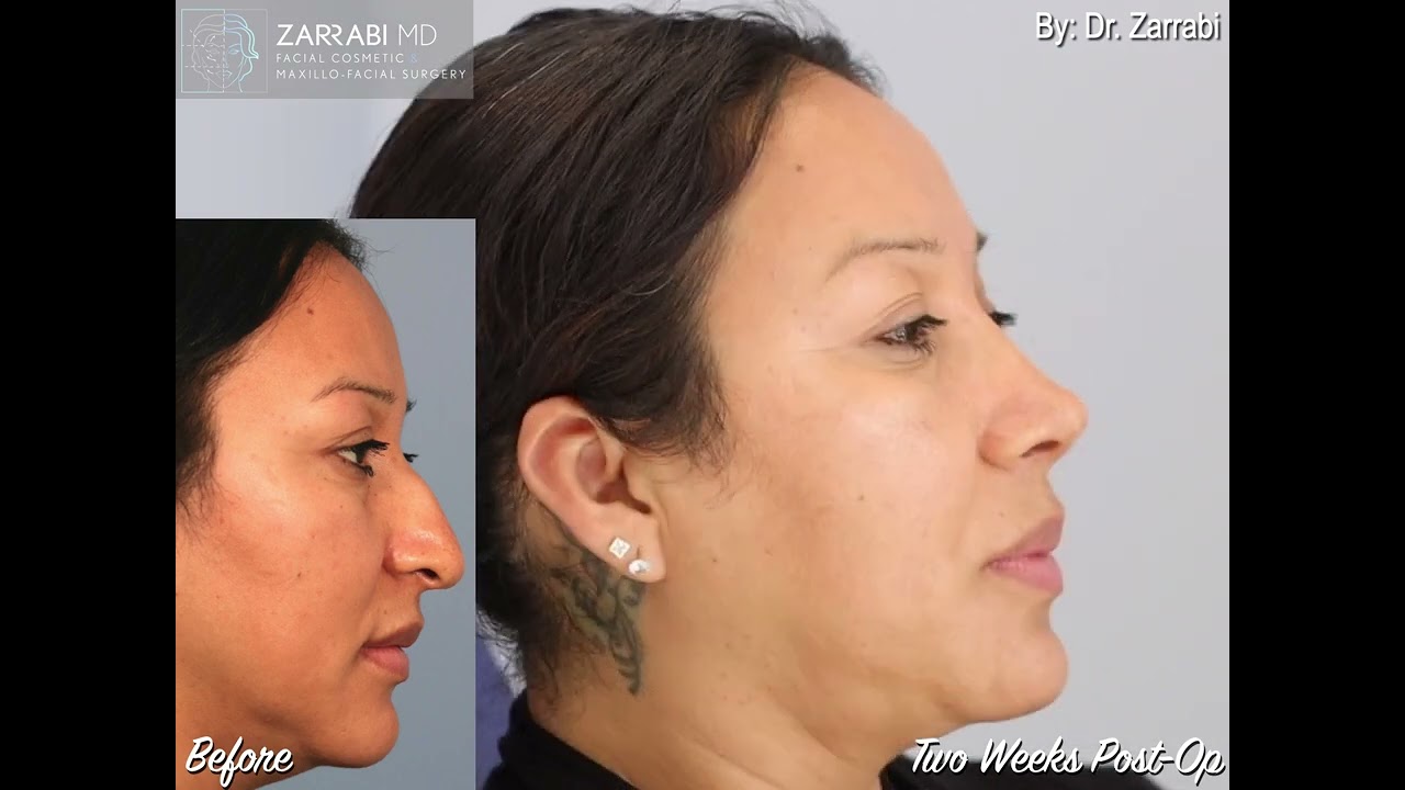 Closed Piezo (Ultrasonic) Rhinoplasty - YouTube