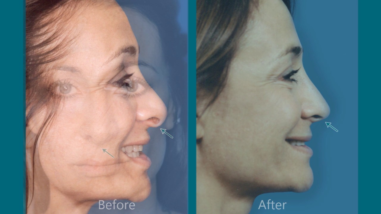 Correcting the Hanging Columella - YouTube