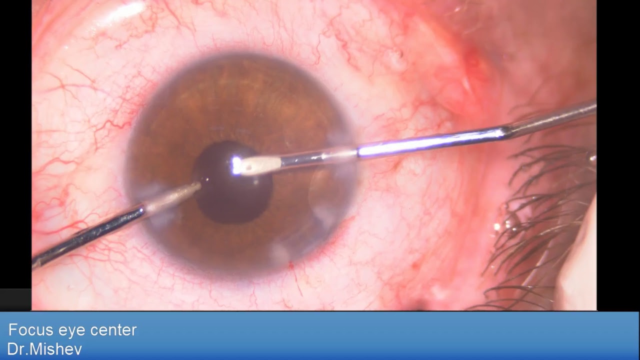 InFo SAV-IOL exchange with Oculentis LS313MF15 Comfort Lukan Mishev ...