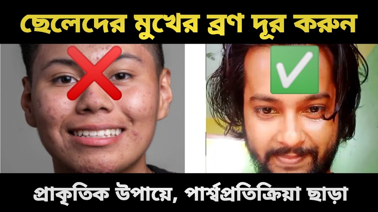 প্রাকৃতিক উপাদান দিয়েই মুখের ব্রণ দূর করুন । ছেলেদের মুখের ব্রণ দূর ...