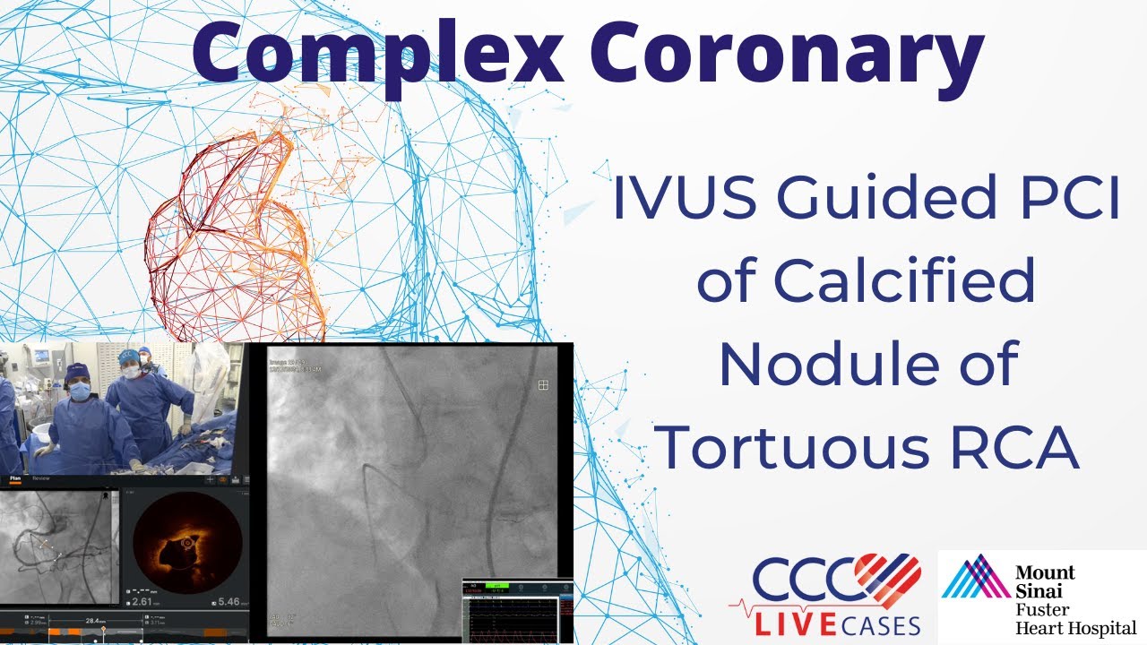 IVUS Guided PCI of Calcified Nodule of Tortuous RCA - YouTube