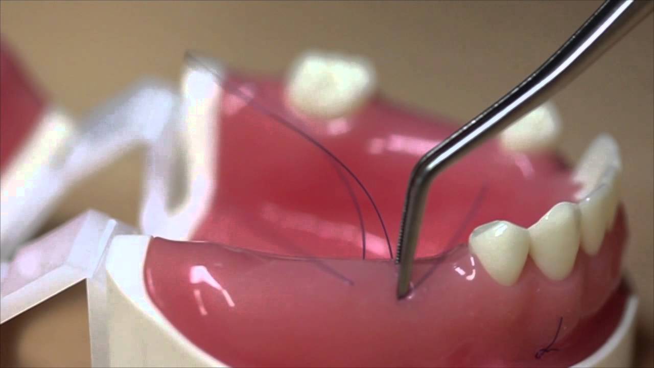 Modified Laurell Suture - YouTube