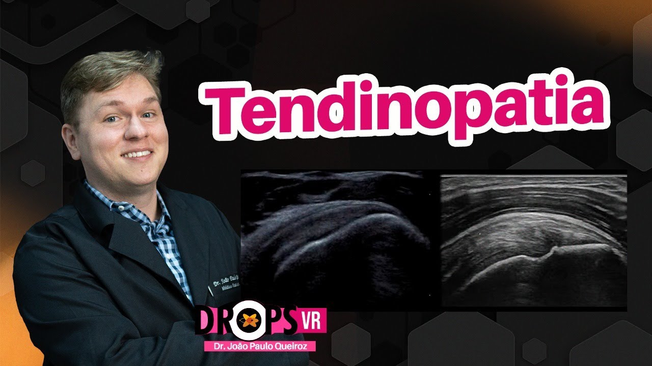 TENDINOSE / TENDINOPATIA I VOCÊ RADIOLOGISTA - YouTube