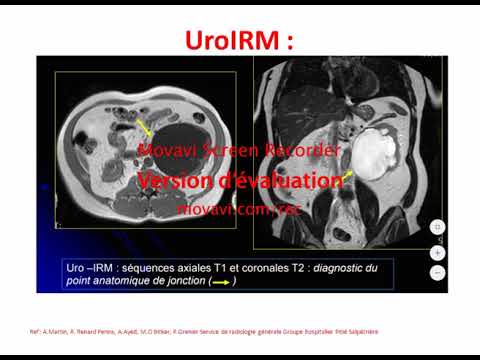 CAT devant syndrome de jonction pyelo ureterale - YouTube