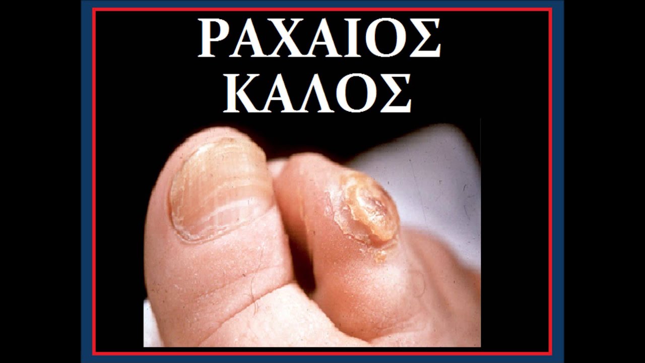 ΠΟΔΟΛΟΓΙΑ-ΠΟΔΟΘΕΡΑΠΕΙΑ - YouTube