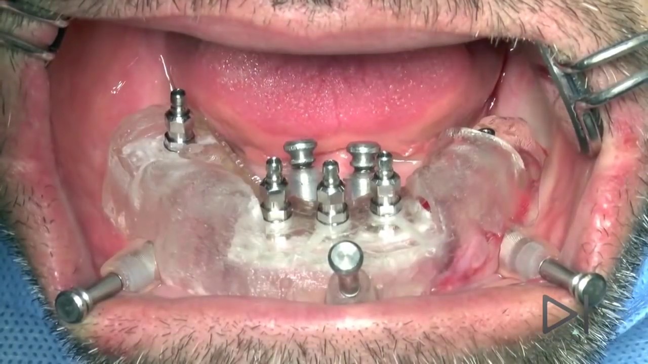 Digital Implantology Implant Surgery: Teeth in a hour with open source ...