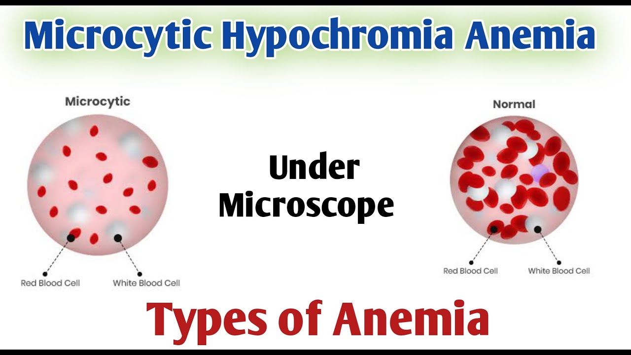 microcytic anemia I microcytic anemia causes - YouTube