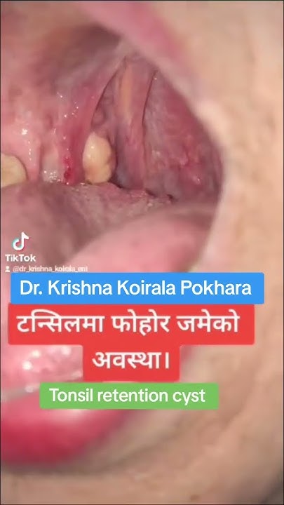 Tonsil retention cyst. // Dr Krishna Koirala Pokhara// - YouTube