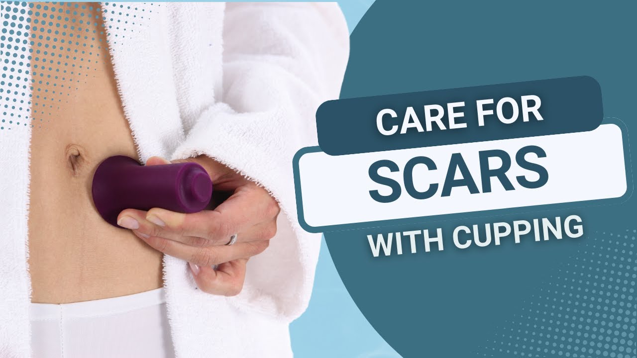 Care for scars with Cupping - YouTube
