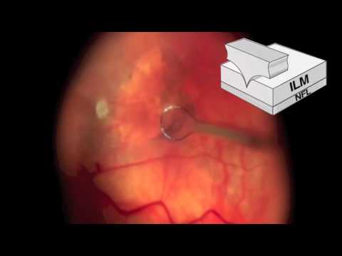 T. Ciulla, MD - ILM Peel with Finesse Flex Loop - YouTube