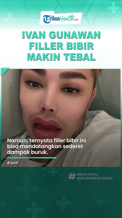 Potret Ivan Gunawan Seusai Filler Bibir Bentuknya Makin Tebal Ketahui