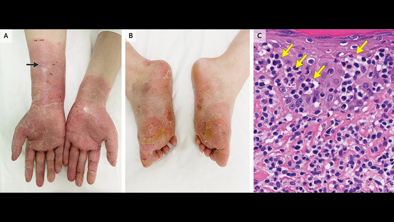 Mycosis fungoides der Handflächen und Fußsohlen - YouTube