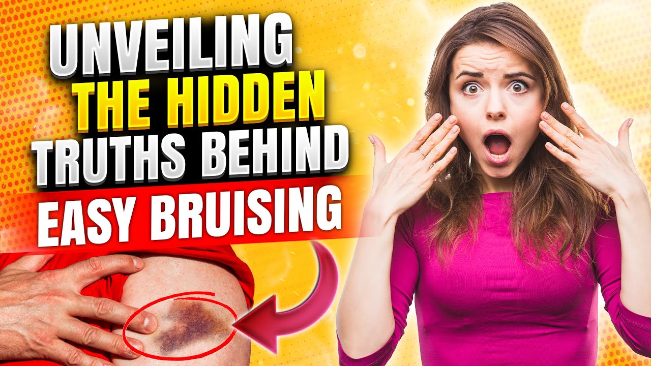 🤔DO YOU BRUISE EASILY? Uncover the Secrets to Preventing Bruising ...