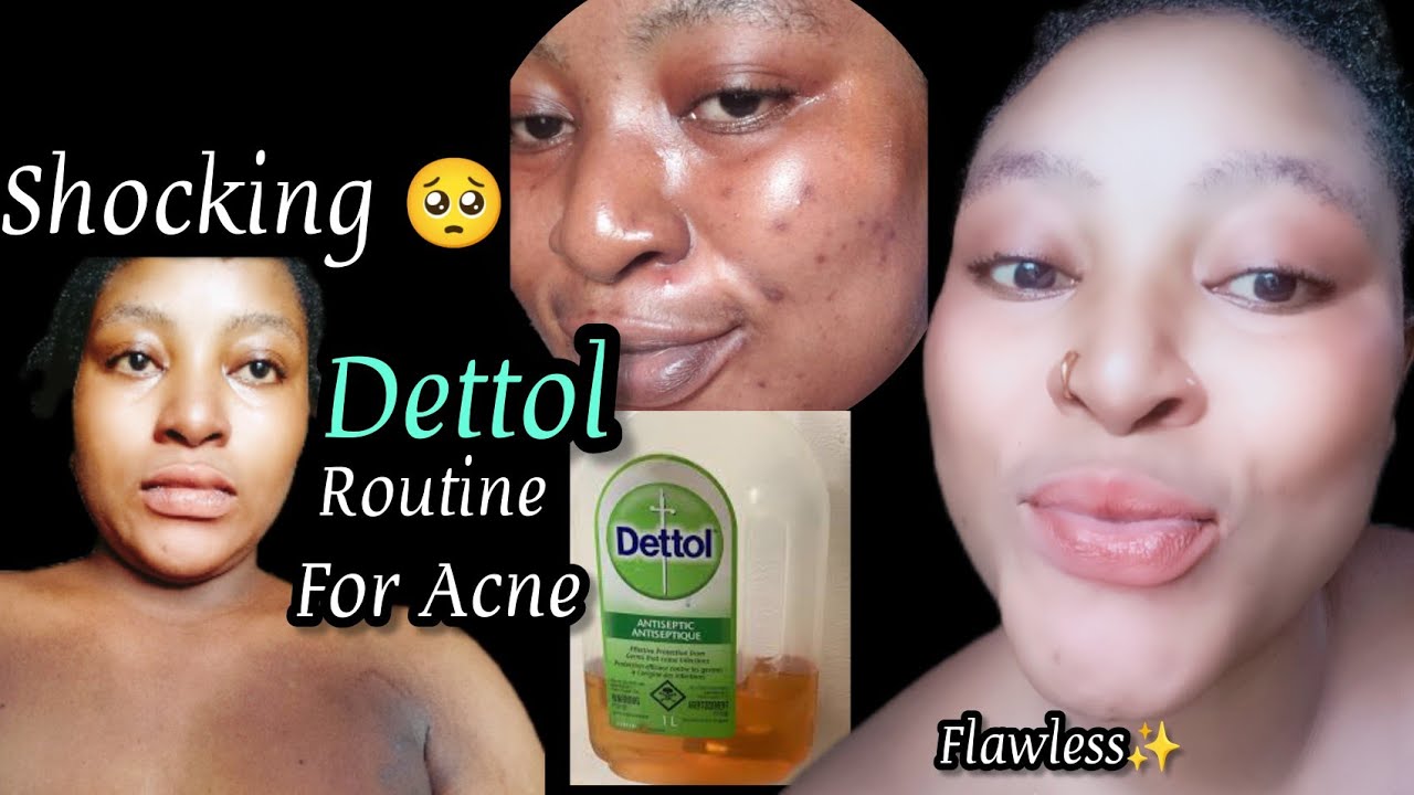 How To Use DETTOL Antiseptic Liquid To Clear Acne & Pimples|Dettol For ...