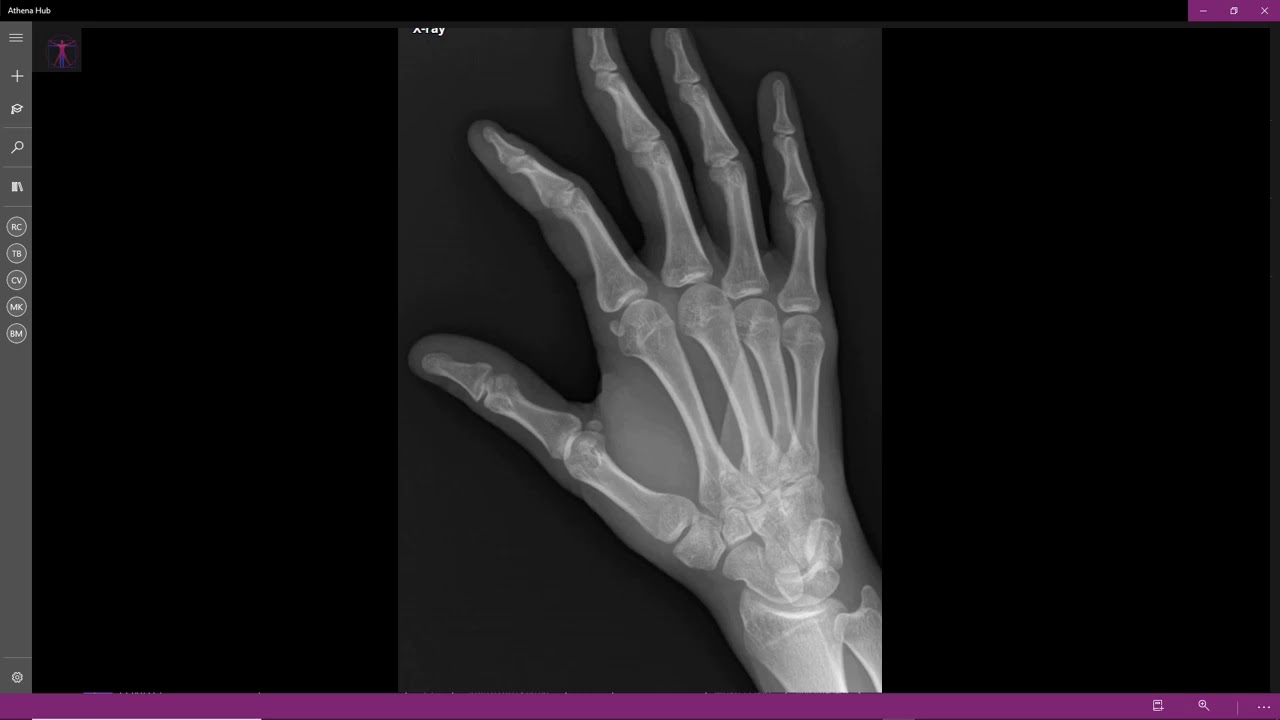 Fratura do Hamato - YouTube